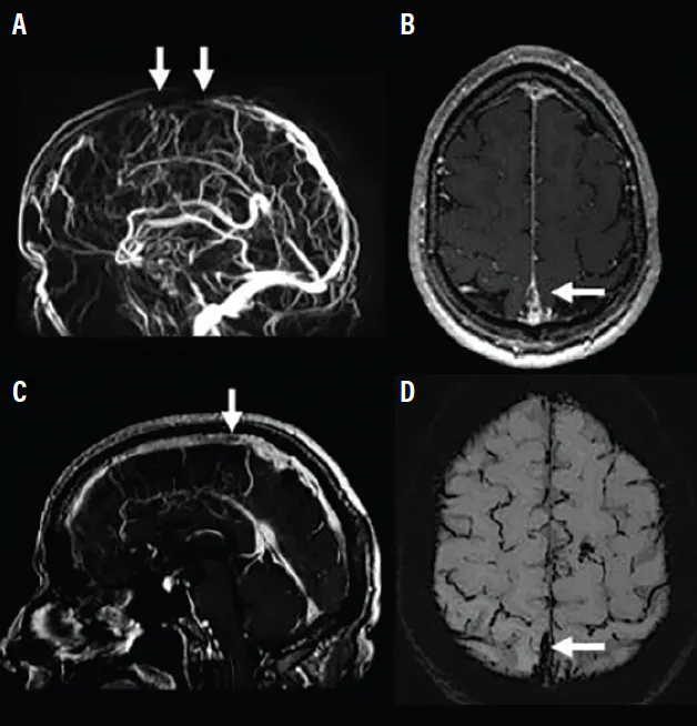 Migraine Brain Scan Migraines Linked To High Sodium Levels In
