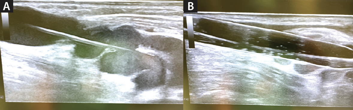 Assisted pAVF Maturation: When, Why, and How I Do It - Endovascular Today