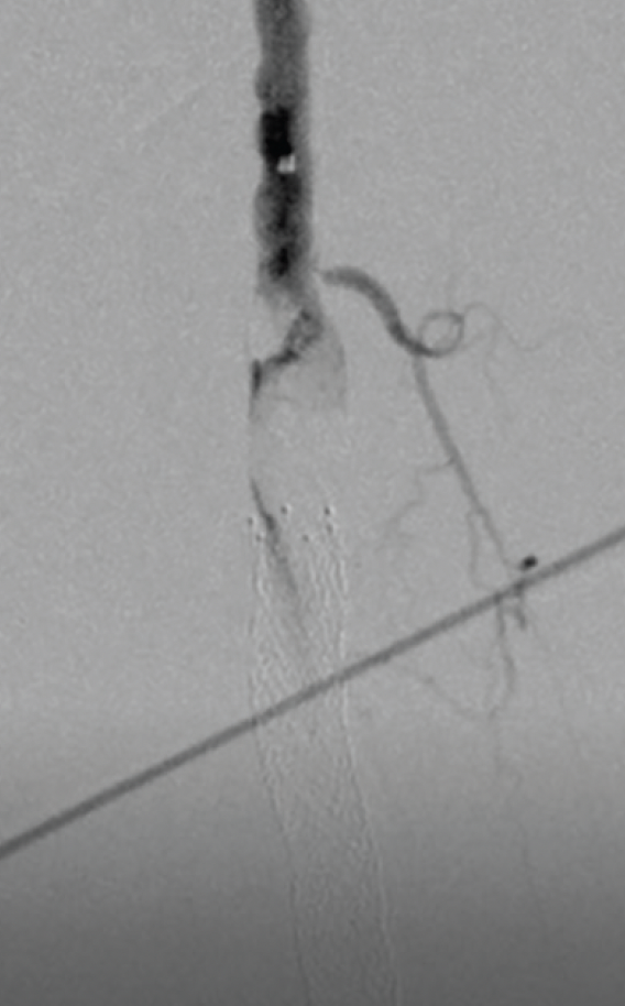 BeBack: An Approach for Heavily Calcified Lesions - Endovascular Today