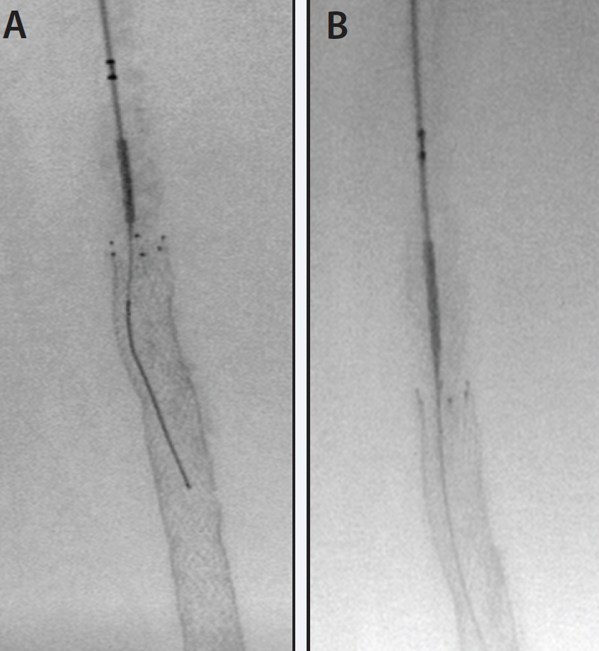 BeBack: An Approach for Heavily Calcified Lesions - Endovascular Today