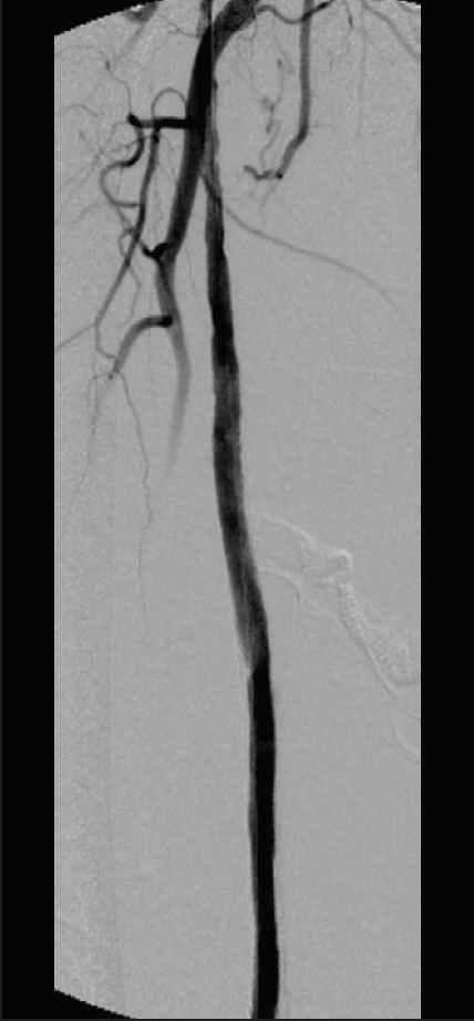 BeBack: An Approach for Heavily Calcified Lesions - Endovascular Today