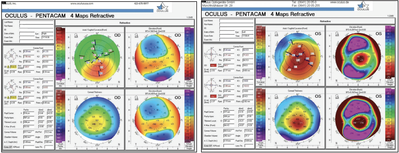 Legal Liability Issues in Keratoconus - Modern Optometry