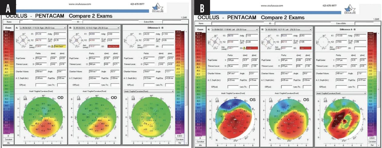 Legal Liability Issues in Keratoconus - Modern Optometry