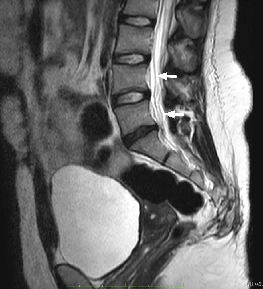 T2weighted Sagittal Mri Showing Spinal Cord Conus Spine