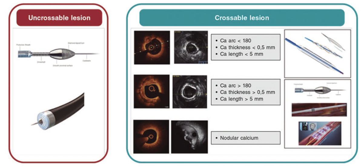 A How-To Guide for Using Intravascular Imaging to Determine Calcium ...