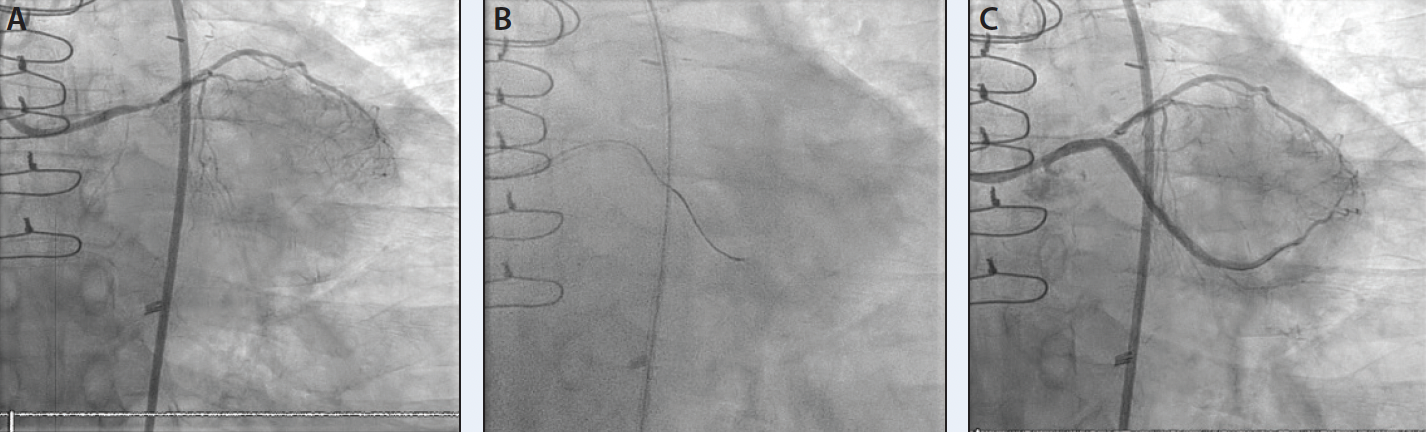 Subintimal Tracking and Reentry: When and How to Do It - Cardiac ...
