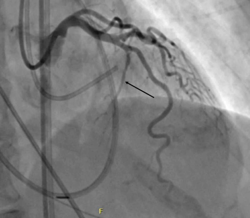 Alcohol Septal Ablation - Cardiac Interventions Today