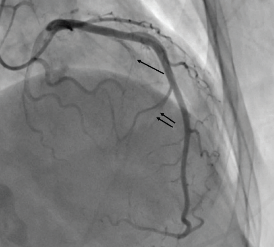 Alcohol Septal Ablation - Cardiac Interventions Today