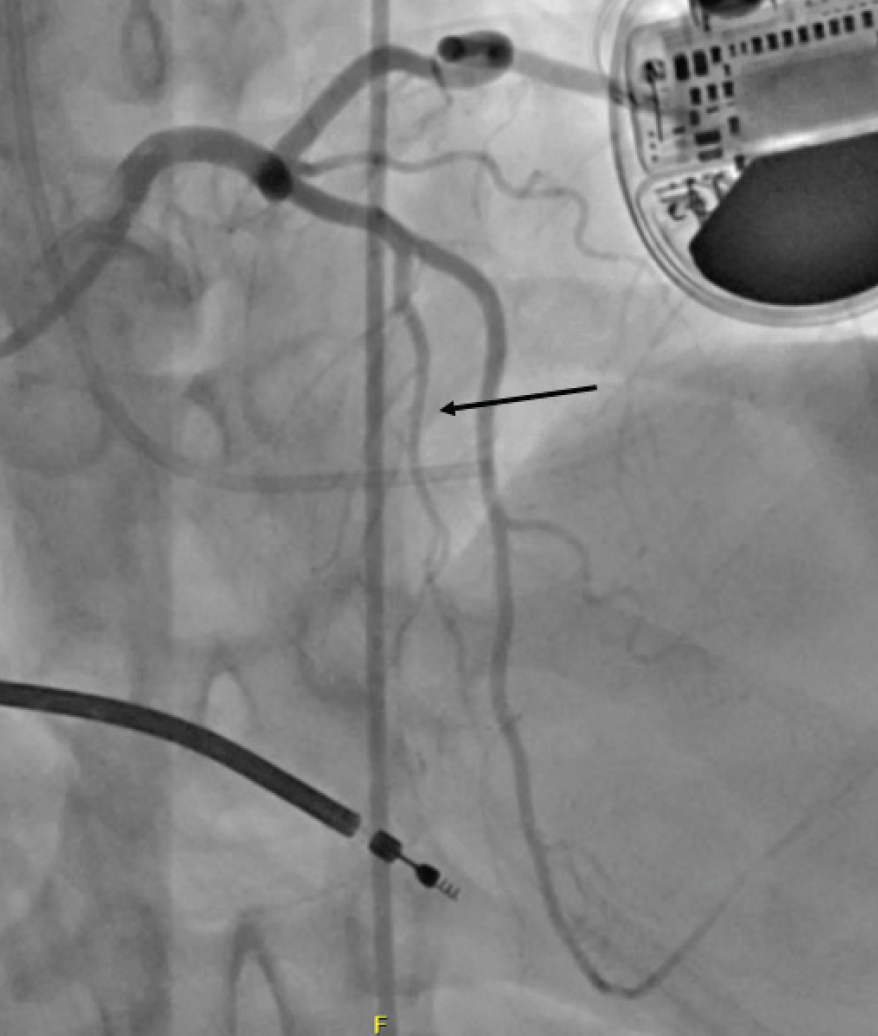 Alcohol Septal Ablation - Cardiac Interventions Today