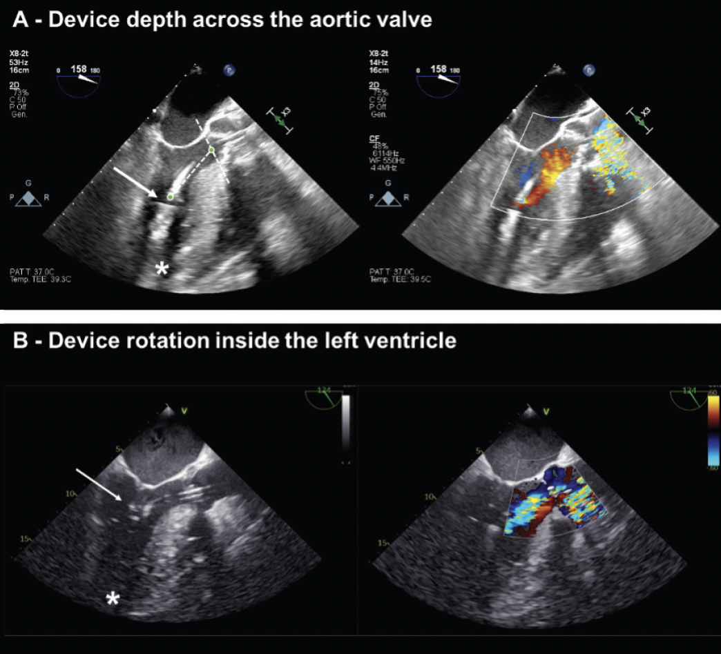 Technical Tips for Inserting and Positioning the Impella Device ...