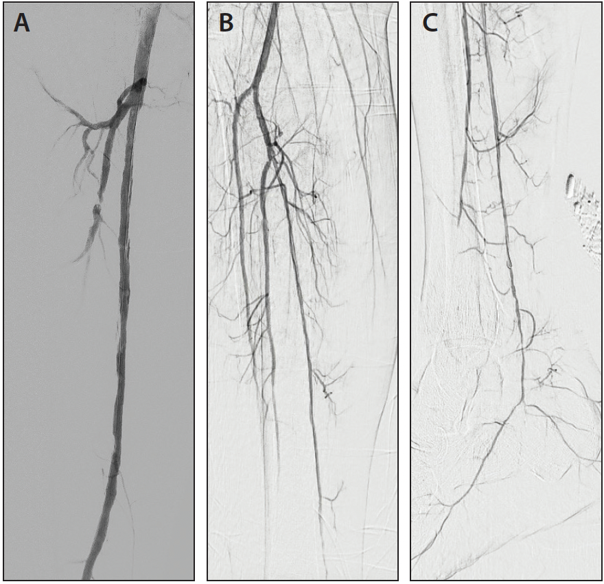 Serration Technology: Achieving Optimal Lumen Gain in Patients With ...