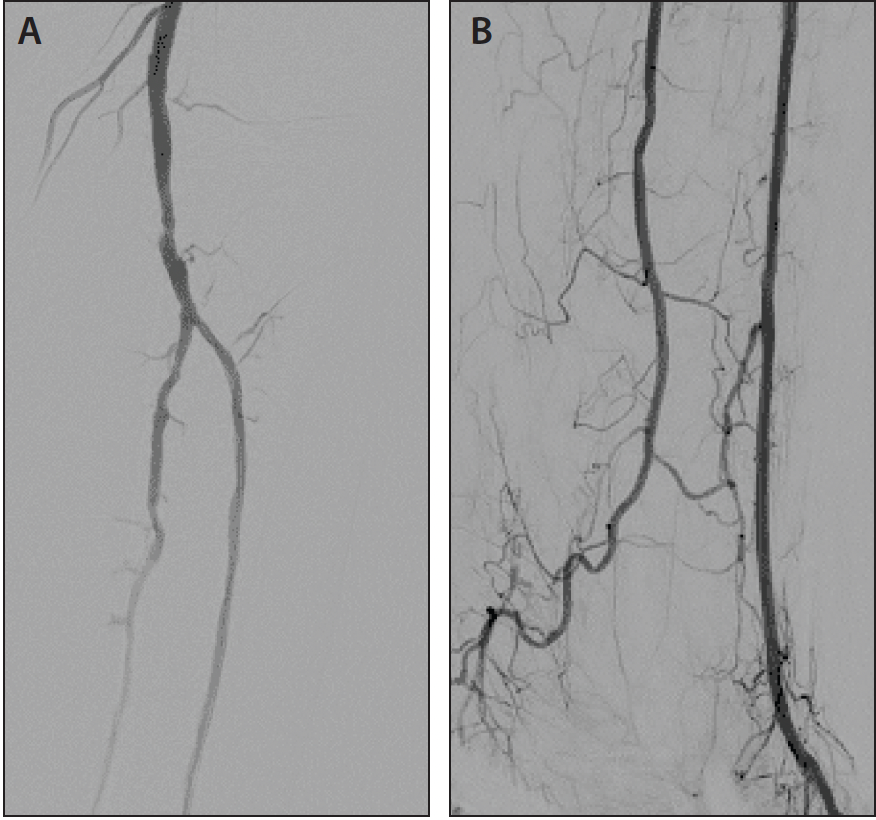 Serration Technology: Achieving Optimal Lumen Gain in Patients With ...