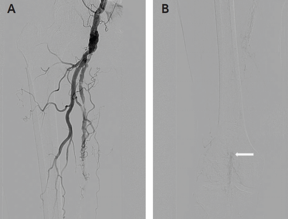 Revascularizing Complex SFA Lesions and CTOs: Is It PTAB with the ...