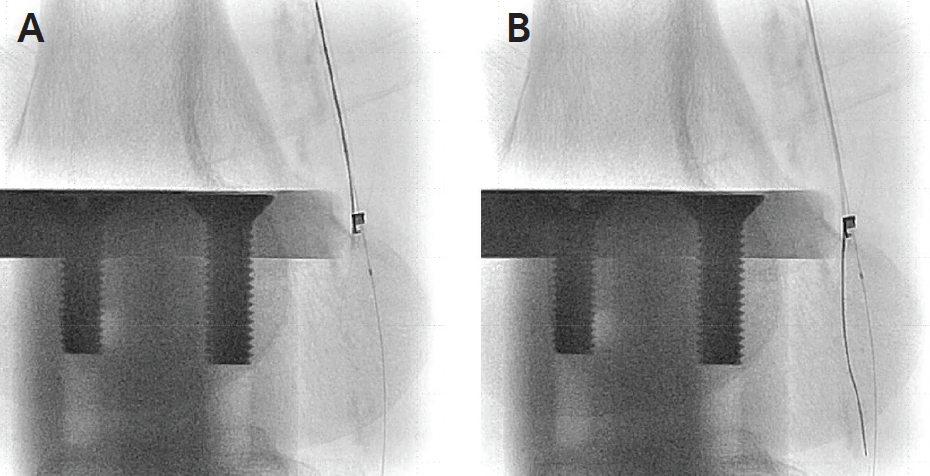 Revascularizing Complex SFA Lesions and CTOs: Is It PTAB with the ...