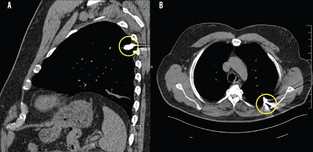 Horner Syndrome Secondary to Bullet Fragments - Modern Optometry