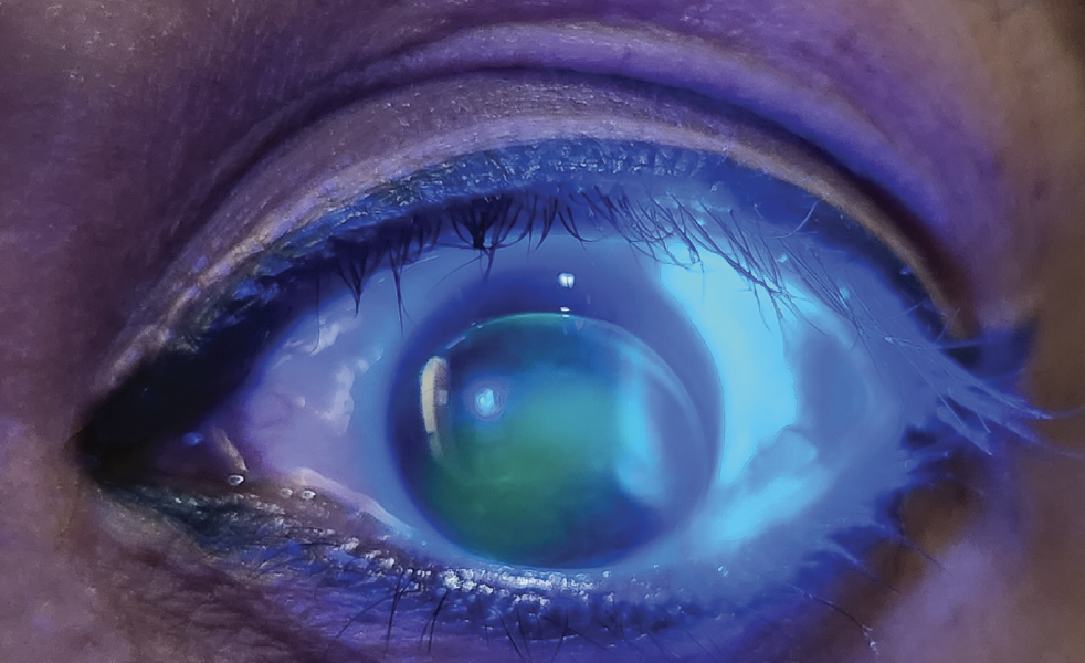 Specialty Lenses for Vision Rehabilitation - Modern Optometry