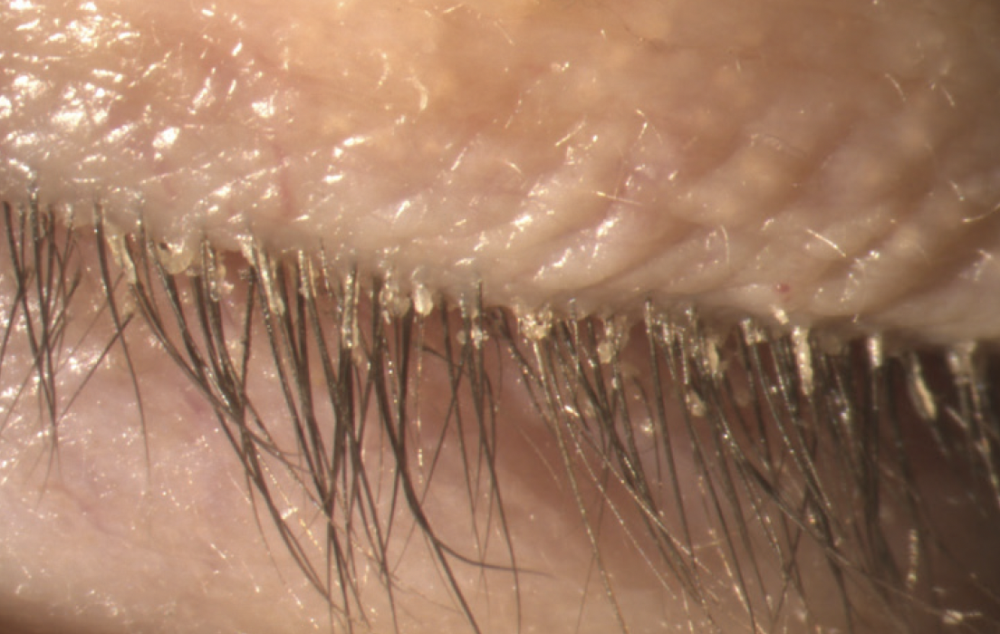 When Lashes Harbor Invaders - Modern Optometry