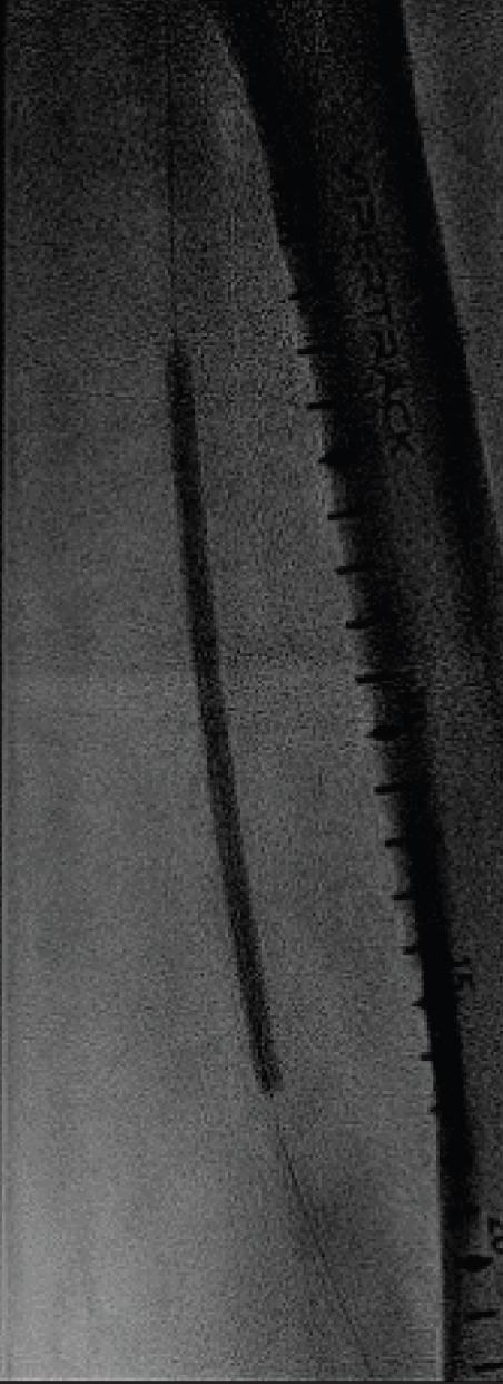 SFA CTO Treated With Serranator and Drug-Eluting Therapy - Endovascular ...