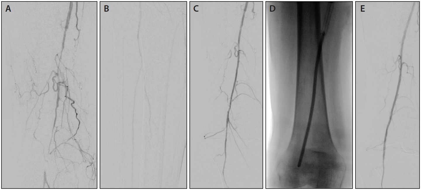 Navigating Complex Femoropopliteal Atherosclerosis: A Surgeon’s ...