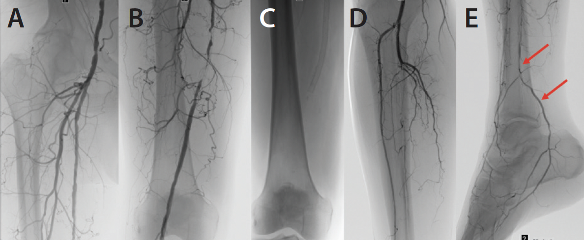 Optimizing DCB Results in the Femoropopliteal Segment - Endovascular Today