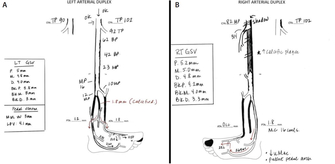 Pedal Acceleration Time Technique for Assessing Revascularization ...