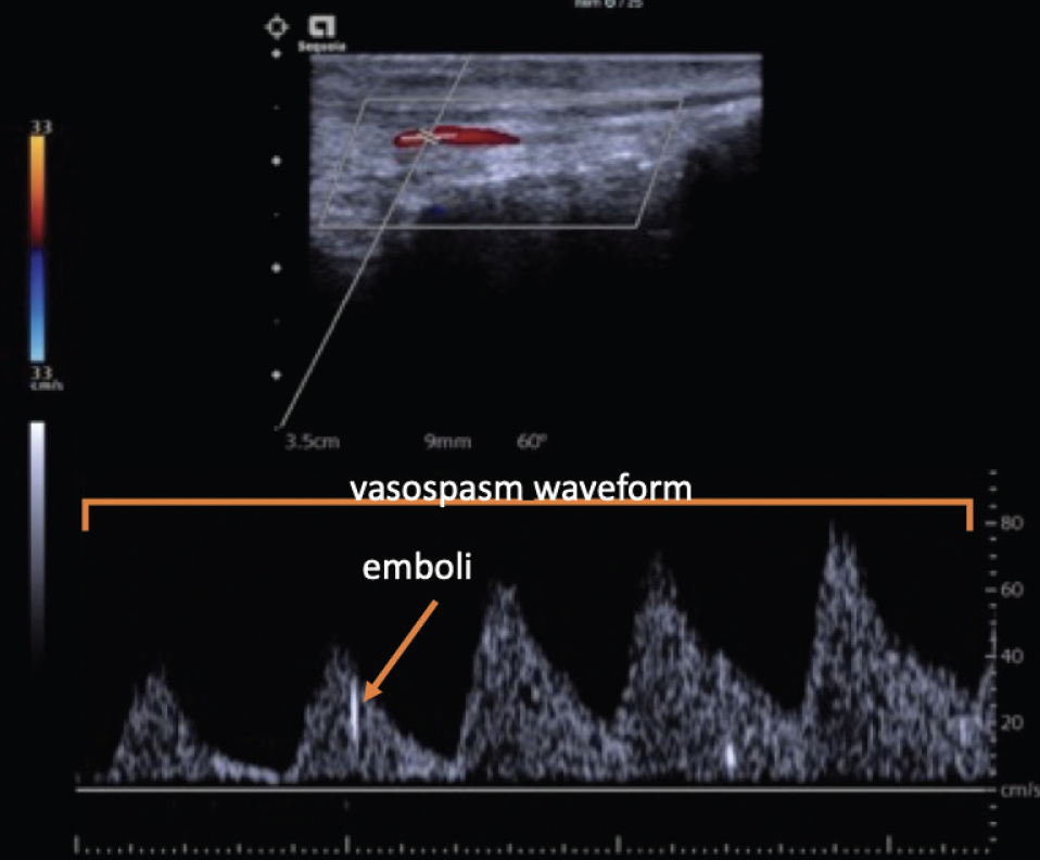 Pedal Acceleration Time Technique for Assessing Revascularization ...