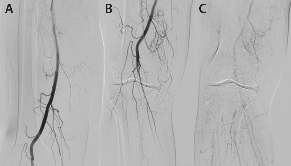 The Utility of the Lightning™ Computer Assisted Vacuum Thrombectomy ...