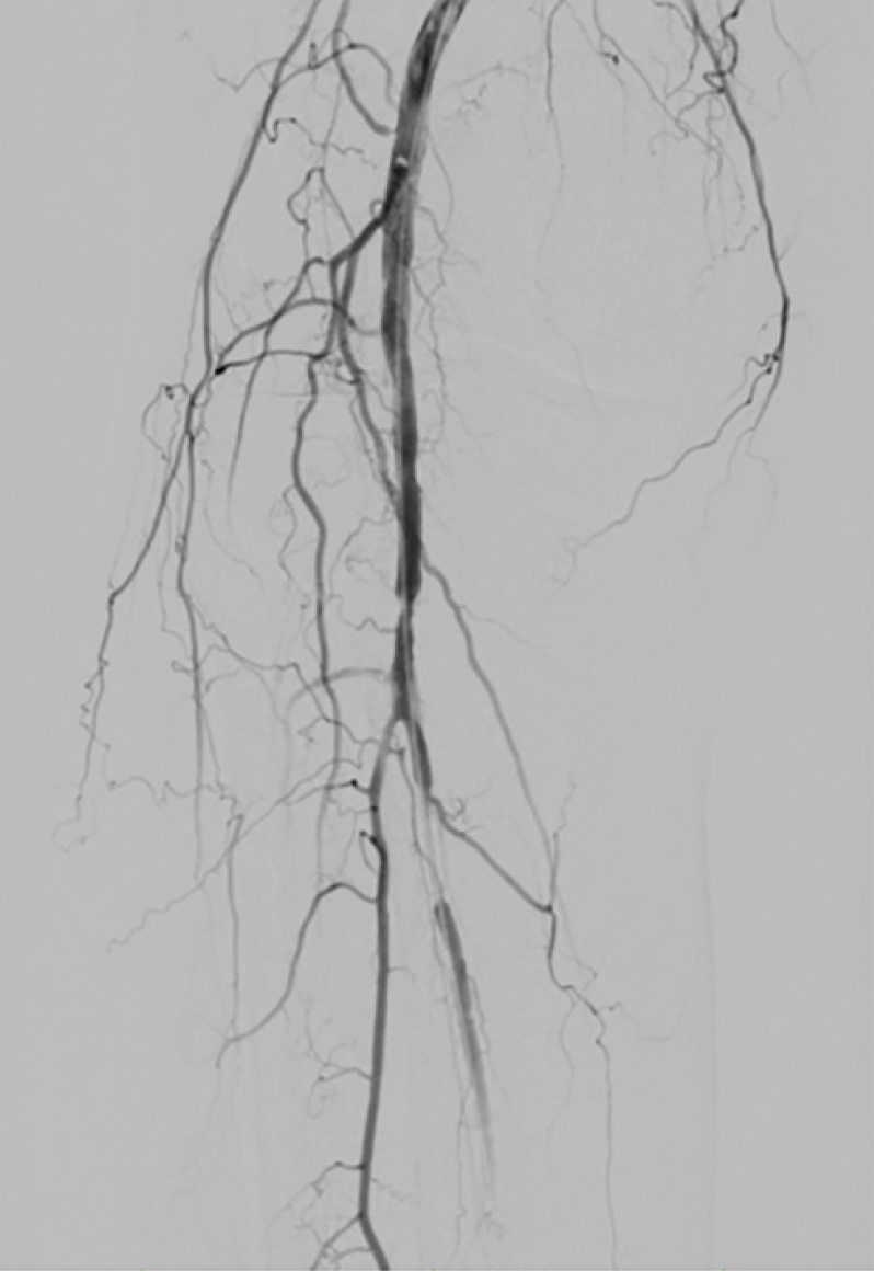 The Utility of the Lightning™ Computer Assisted Vacuum Thrombectomy ...