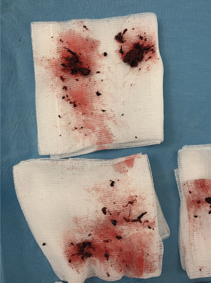 The Utility of the Lightning™ Computer Assisted Vacuum Thrombectomy ...
