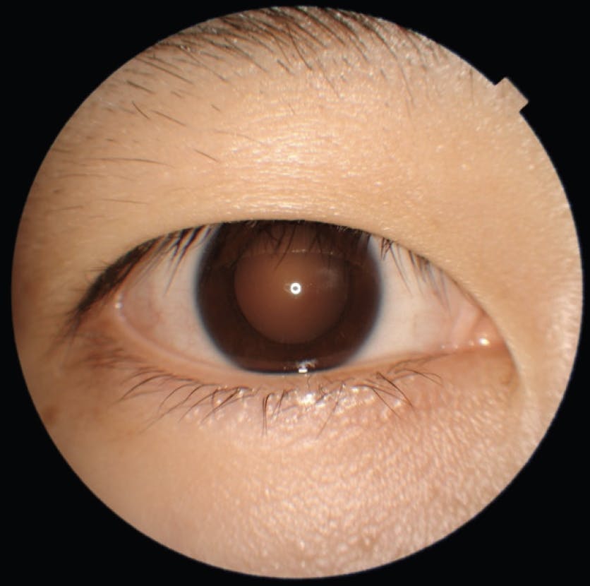 Phlyctenular Keratoconjunctivitis Acne Rosacea Phlyctenular Keratitis