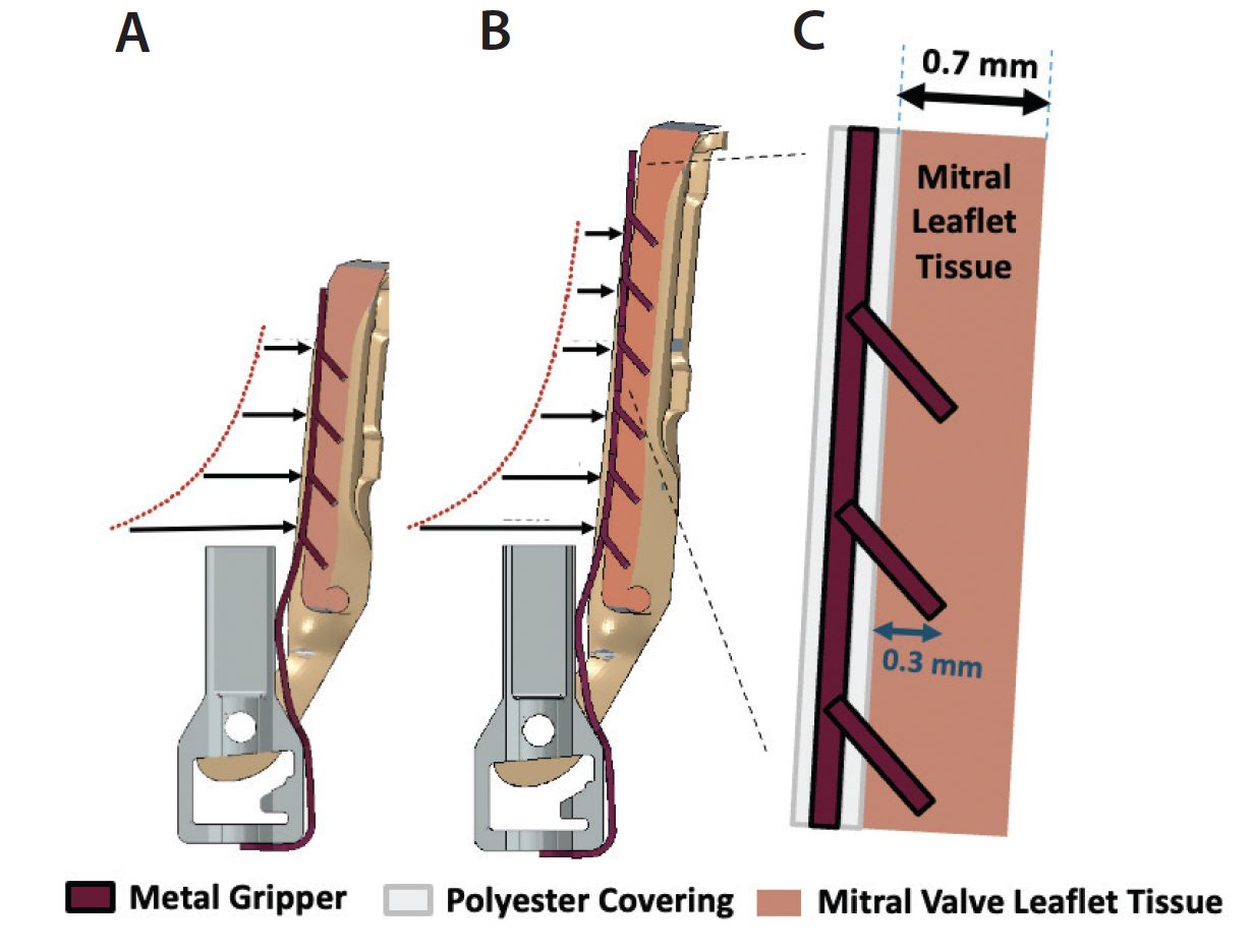 Design, Development, and Clinical Experience of Four MitraClip™ Device ...