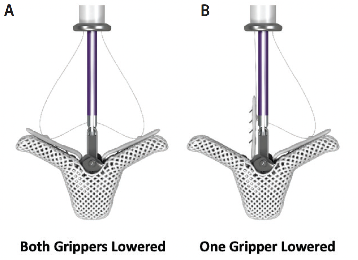 Design, Development, and Clinical Experience of Four MitraClip™ Device ...