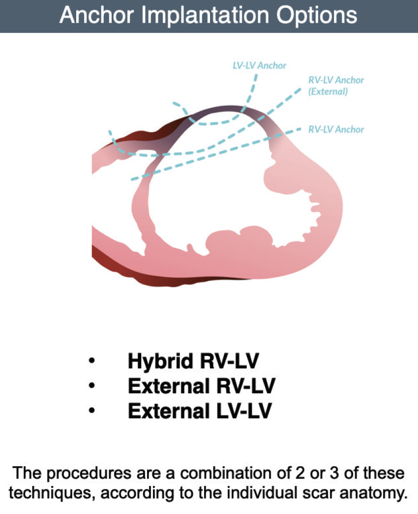 Less Invasive Ventricular Enhancement: The LIVE Procedure and Design of ...