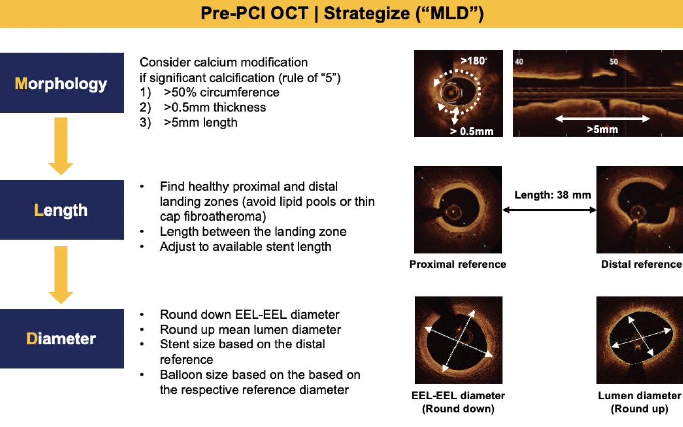 OCT-Guided PCI: Lessons From the ILUMIEN IV: OPTIMAL PCI Trial ...