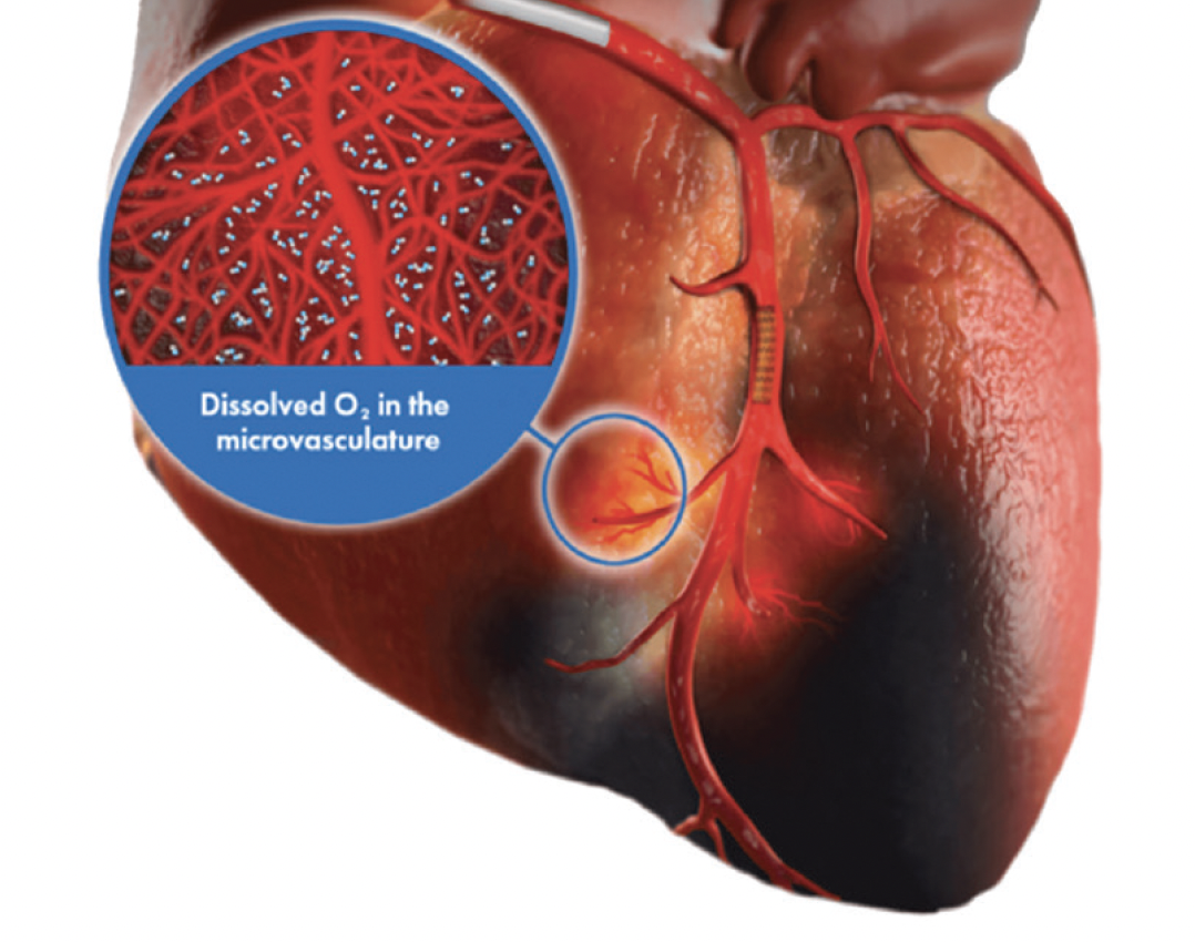 SuperSaturated Oxygen Therapy (SSO2): Left Ventricular Improvement in ...