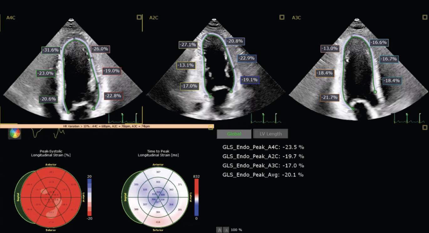 SuperSaturated Oxygen Therapy (SSO2): Left Ventricular Improvement in Anterior STEMI - Cardiac ...