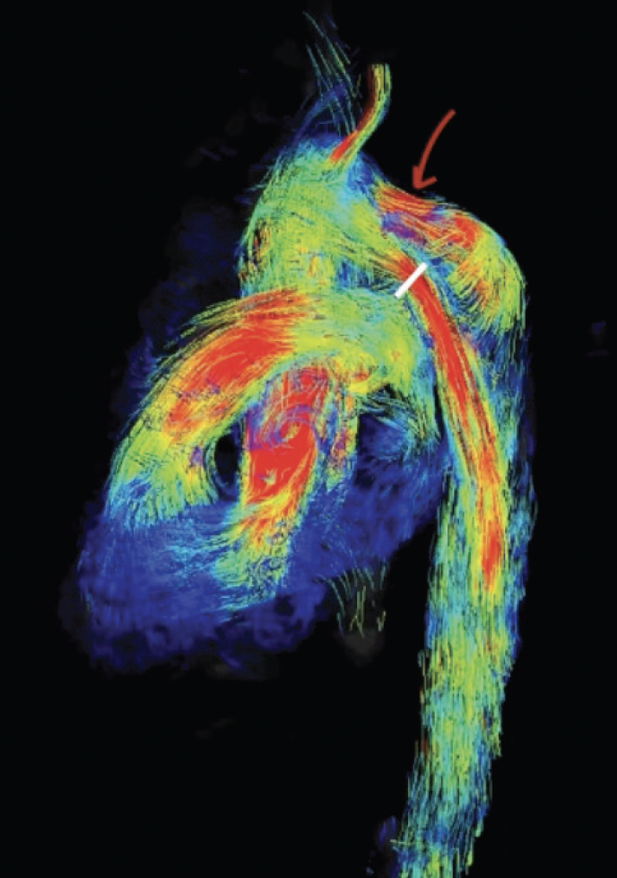 Anatomic Considerations for Treating Malperfusion in Type B Aortic ...