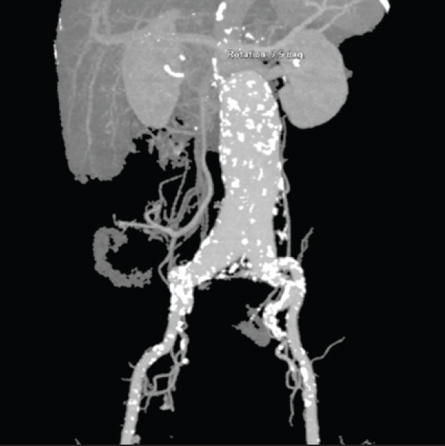 Integrating Shockwave Peripheral IVL Into Our EVAR/TEVAR Practice ...