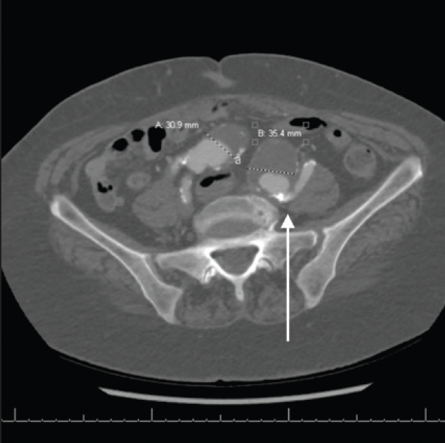 Integrating Shockwave Peripheral IVL Into Our EVAR/TEVAR Practice ...