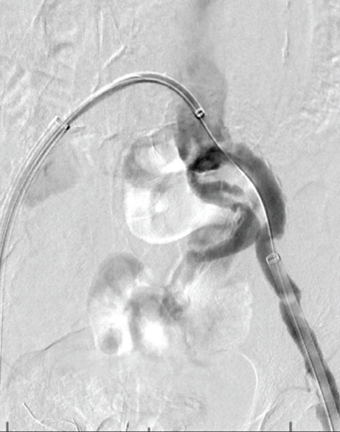 Integrating Shockwave Peripheral IVL Into Our EVAR/TEVAR Practice ...