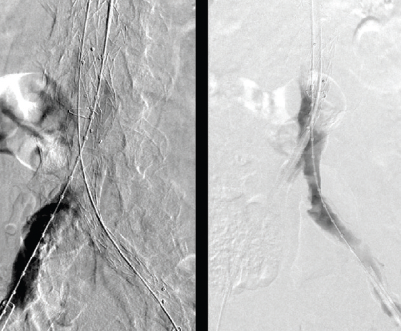 Integrating Shockwave Peripheral IVL Into Our EVAR/TEVAR Practice ...