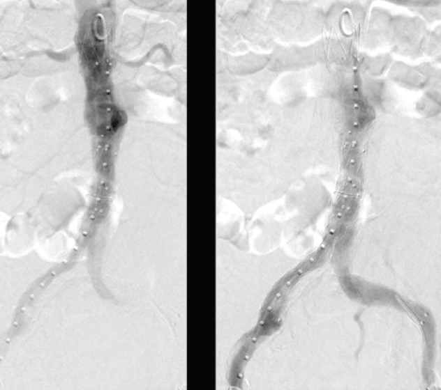 Integrating Shockwave Peripheral IVL Into Our EVAR/TEVAR Practice ...