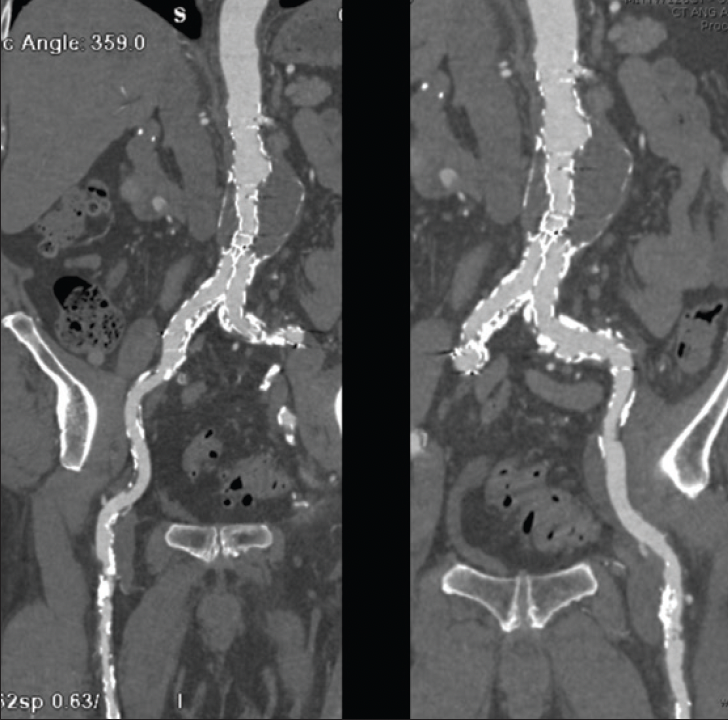 Integrating Shockwave Peripheral IVL Into Our EVAR/TEVAR Practice ...