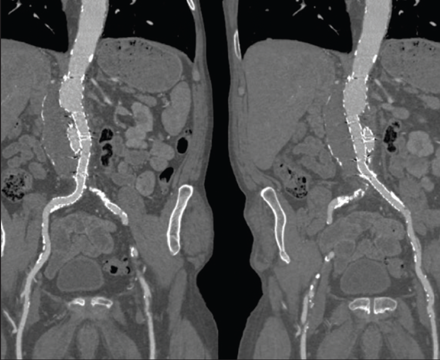 Integrating Shockwave Peripheral IVL Into Our EVAR/TEVAR Practice ...