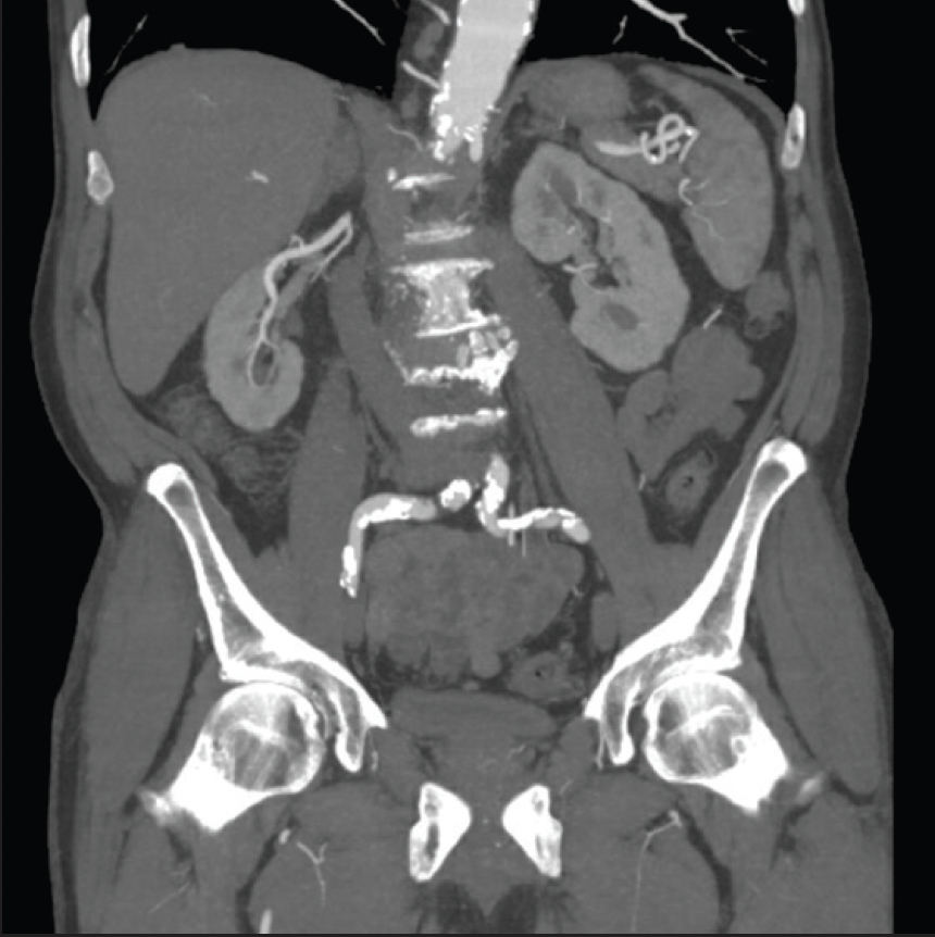 Integrating Shockwave Peripheral IVL Into Our EVAR/TEVAR Practice ...