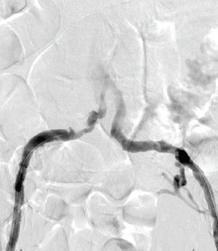 Integrating Shockwave Peripheral IVL Into Our EVAR/TEVAR Practice ...