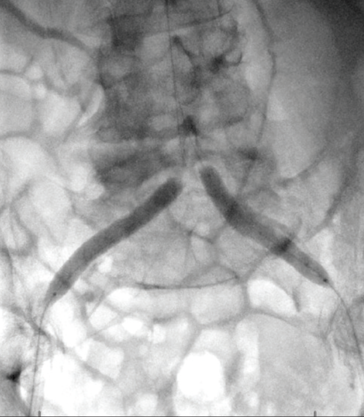 Integrating Shockwave Peripheral IVL Into Our EVAR/TEVAR Practice ...
