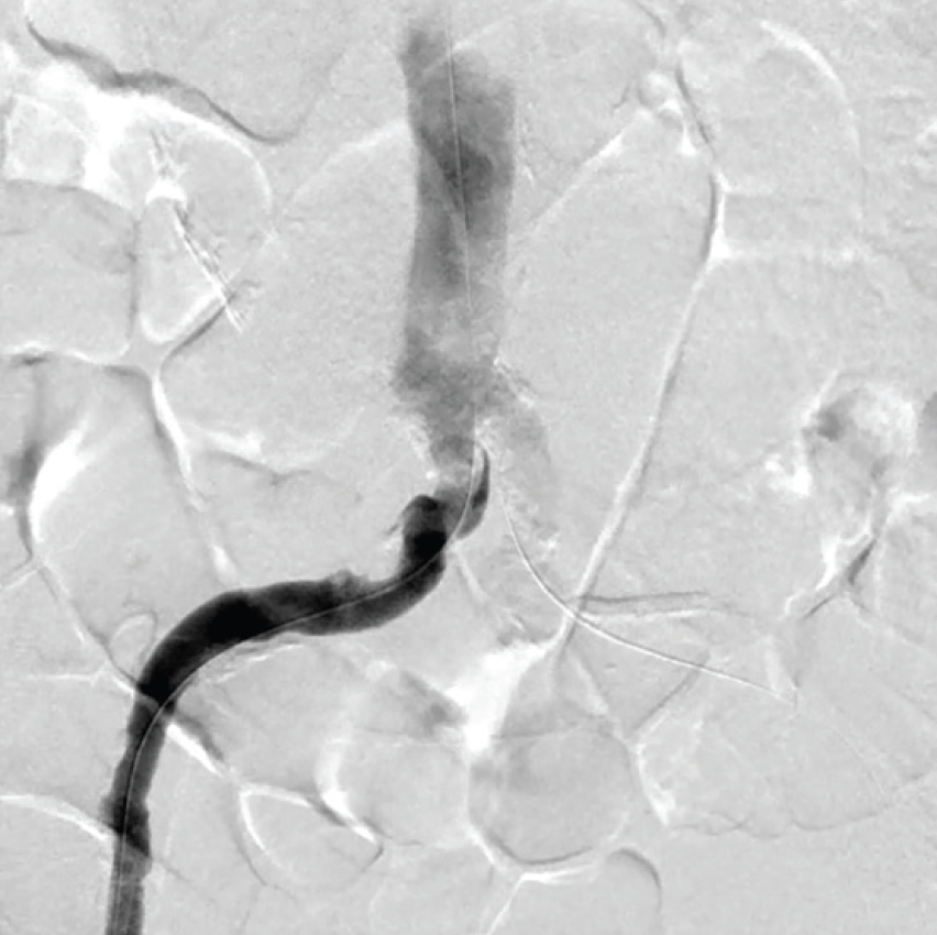 Integrating Shockwave Peripheral IVL Into Our EVAR/TEVAR Practice ...