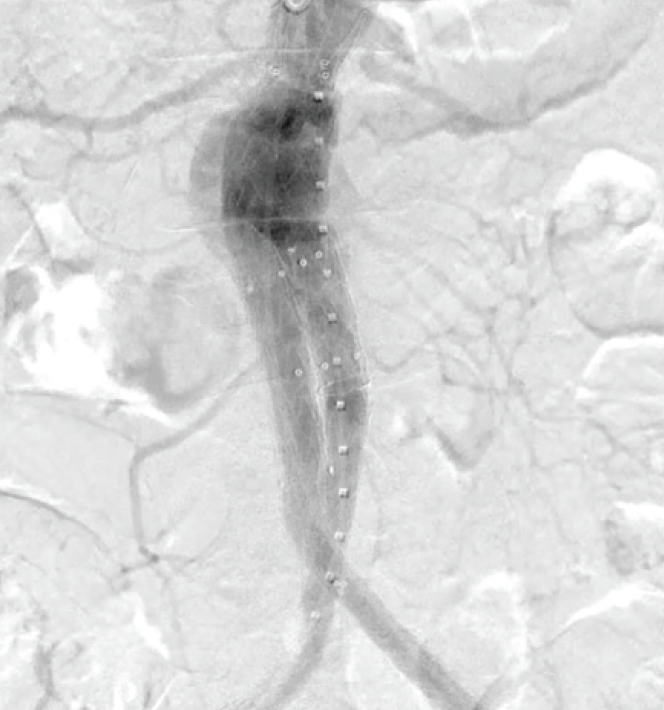 Integrating Shockwave Peripheral IVL Into Our EVAR/TEVAR Practice ...