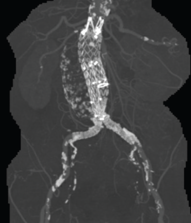 Integrating Shockwave Peripheral IVL Into Our EVAR/TEVAR Practice ...